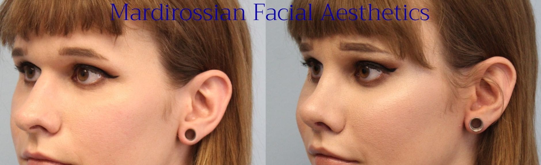 Cheek Implants in McLean, VA