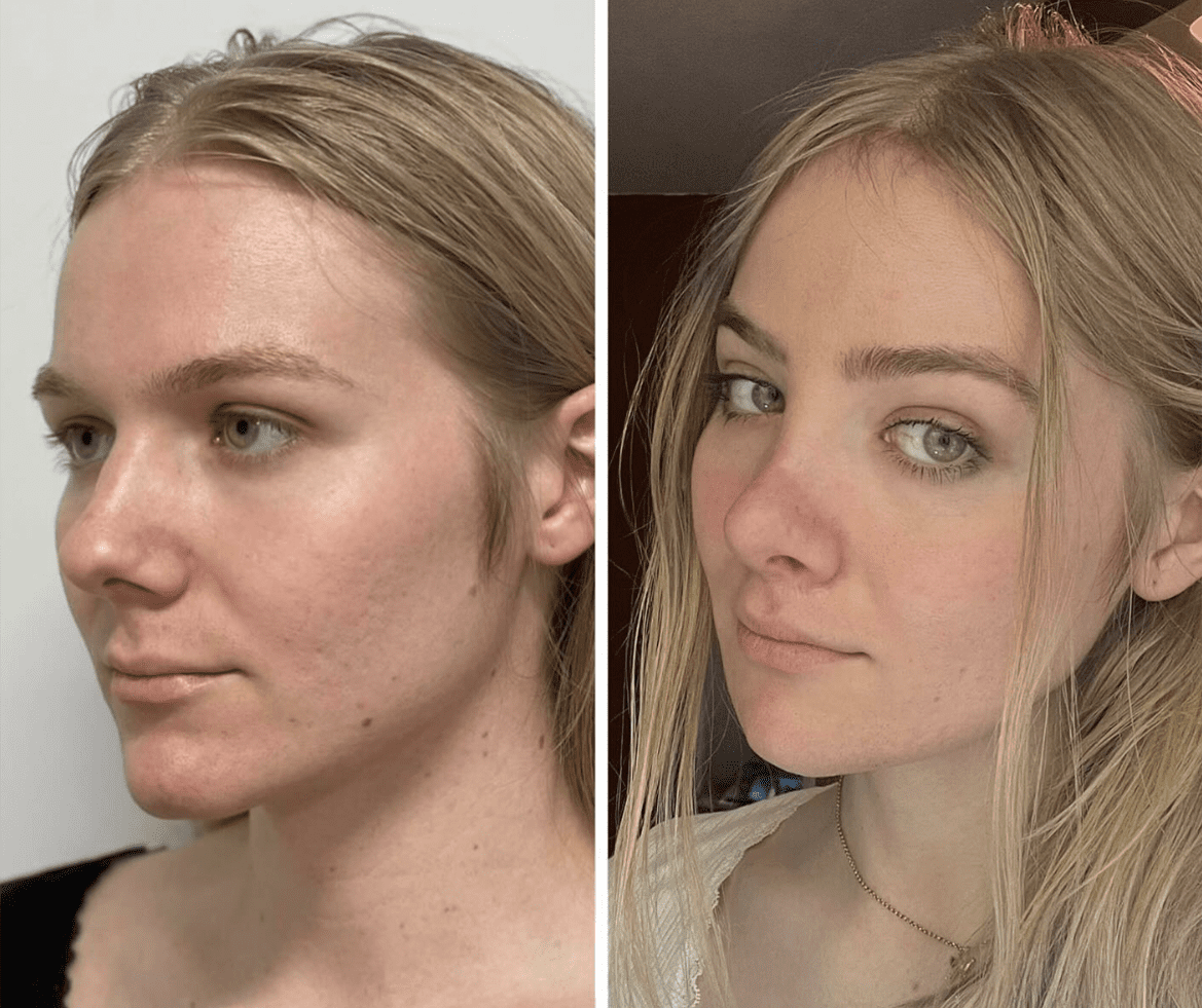 Facial Feminization Surgery FFS McLean VA McLean VA FFS